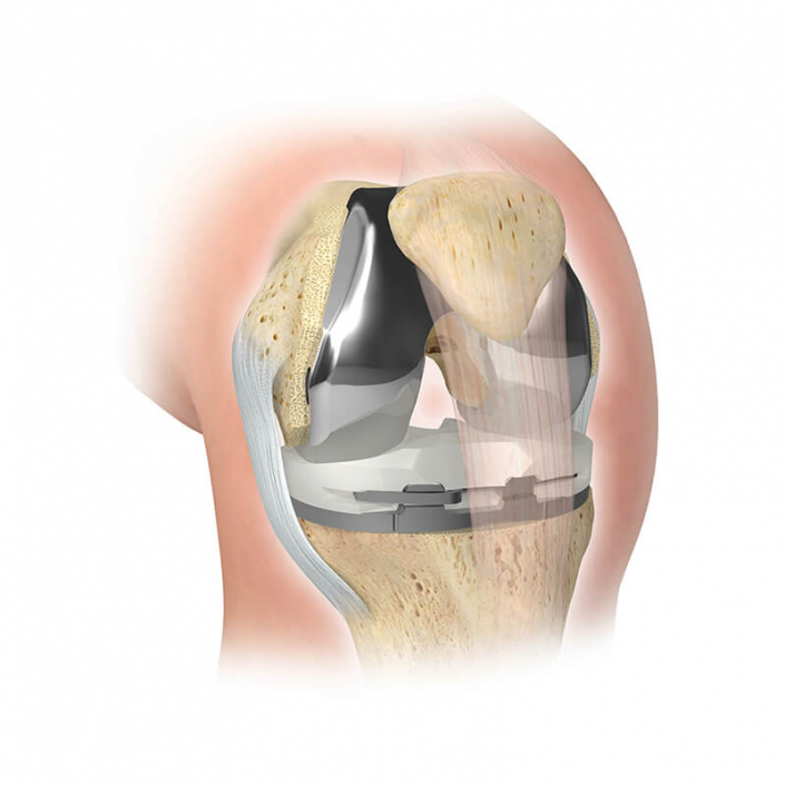 Implante De Rodilla : Implantes de artroplastia de rodilla – KQTRUC
